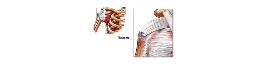 Leziunile de coafa rotatorie - Ina Medical Sport