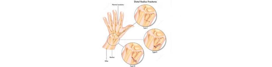 Fractura distala de radius - Ina Medical Sport