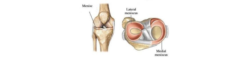 Ruptura , leziune de menisc - Ina Medical Sport